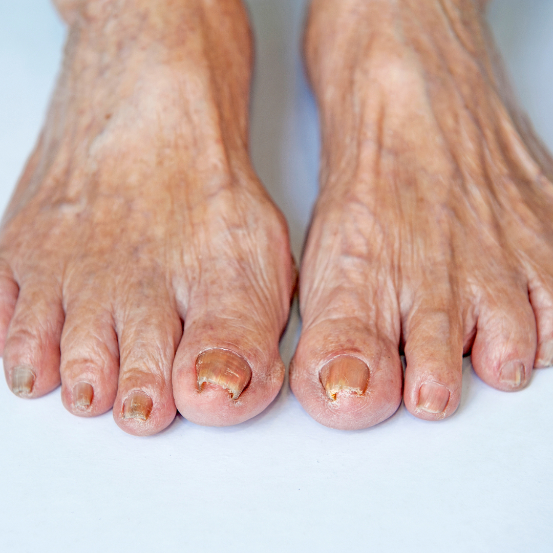 Toenail Abnormalities: What They Reveal About Your Overall Health